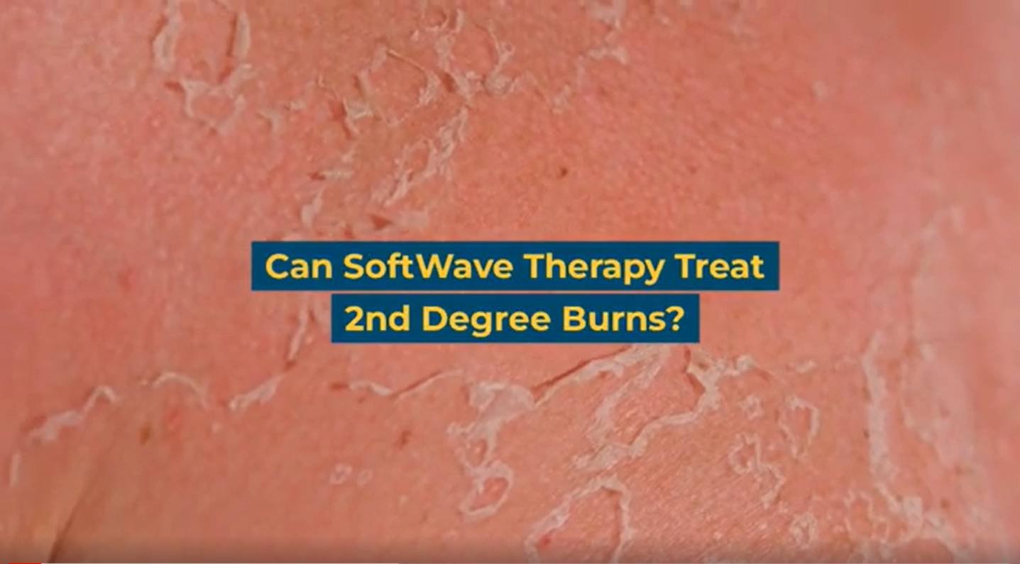 Can SoftWave Therapy Help Treat 2nd-Degree Burns? - SoftWave